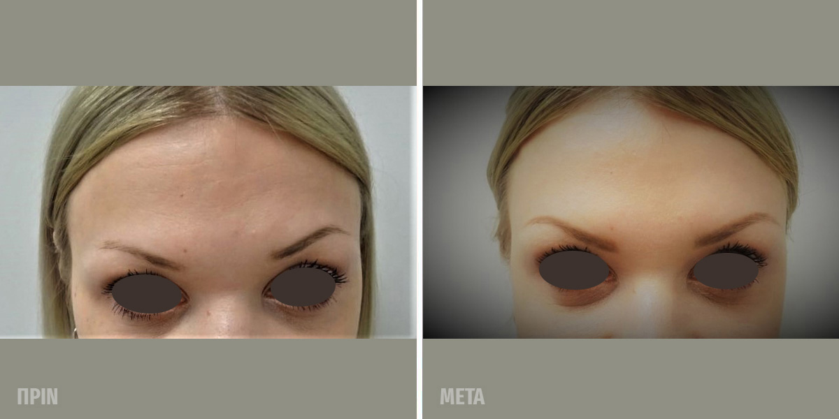 Botox & Αποτελέσματα: Δείτε τα Πριν & Μετά και Μάθετε τα Οφέλη της ...