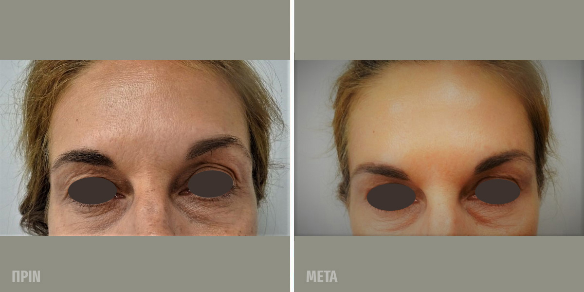 Botox & Αποτελέσματα: Δείτε τα Πριν & Μετά και Μάθετε τα Οφέλη της ...