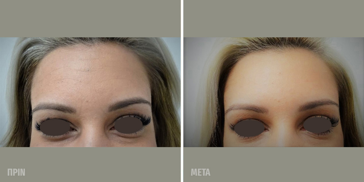 Botox & Αποτελέσματα: Δείτε τα Πριν & Μετά και Μάθετε τα Οφέλη της ...